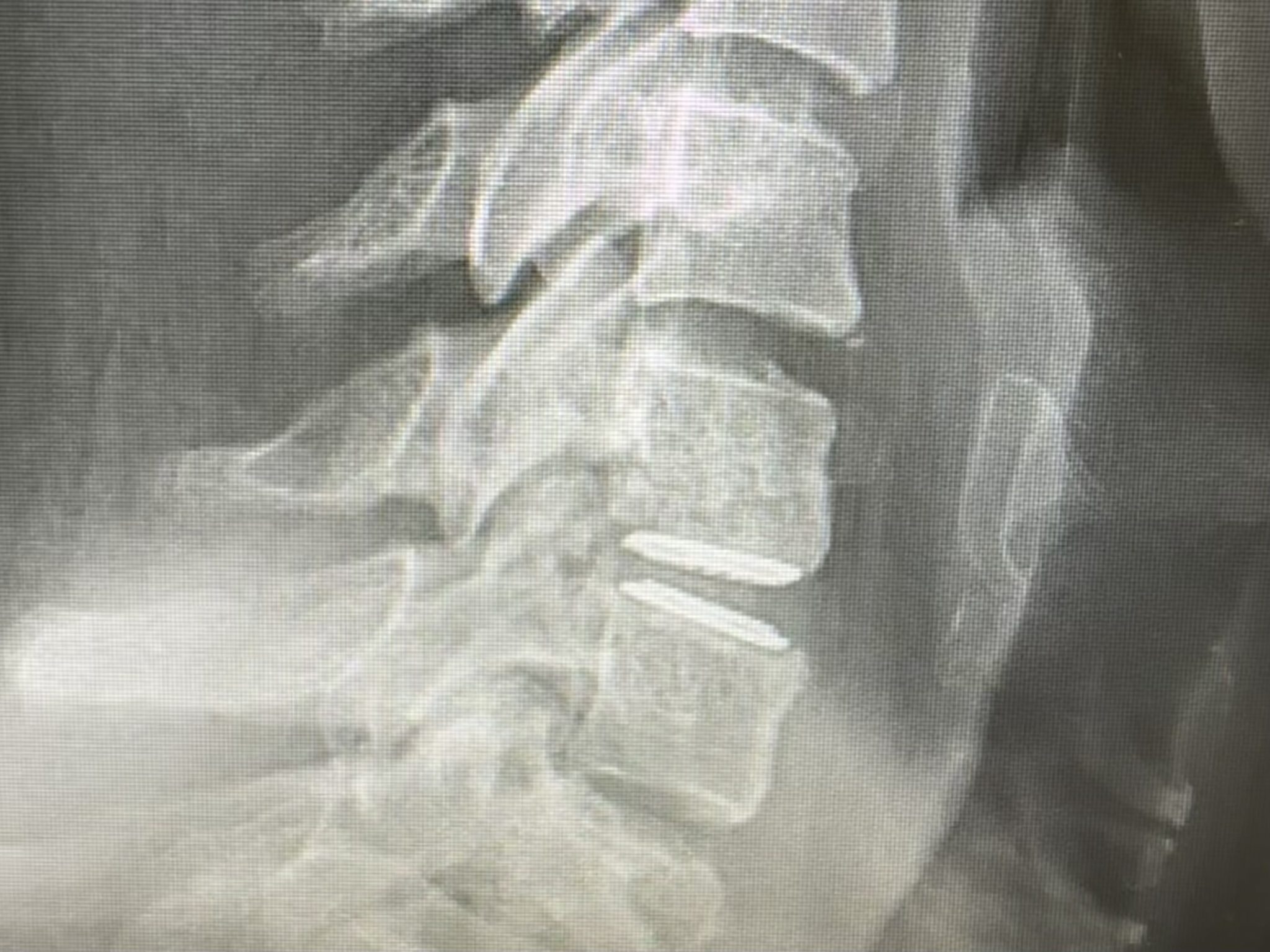 Cervical Artificial Disc Replacement - CDA Spine