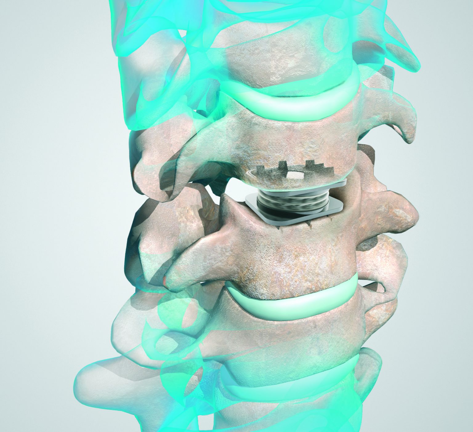 Cervical Artificial Disc Replacement - CDA Spine