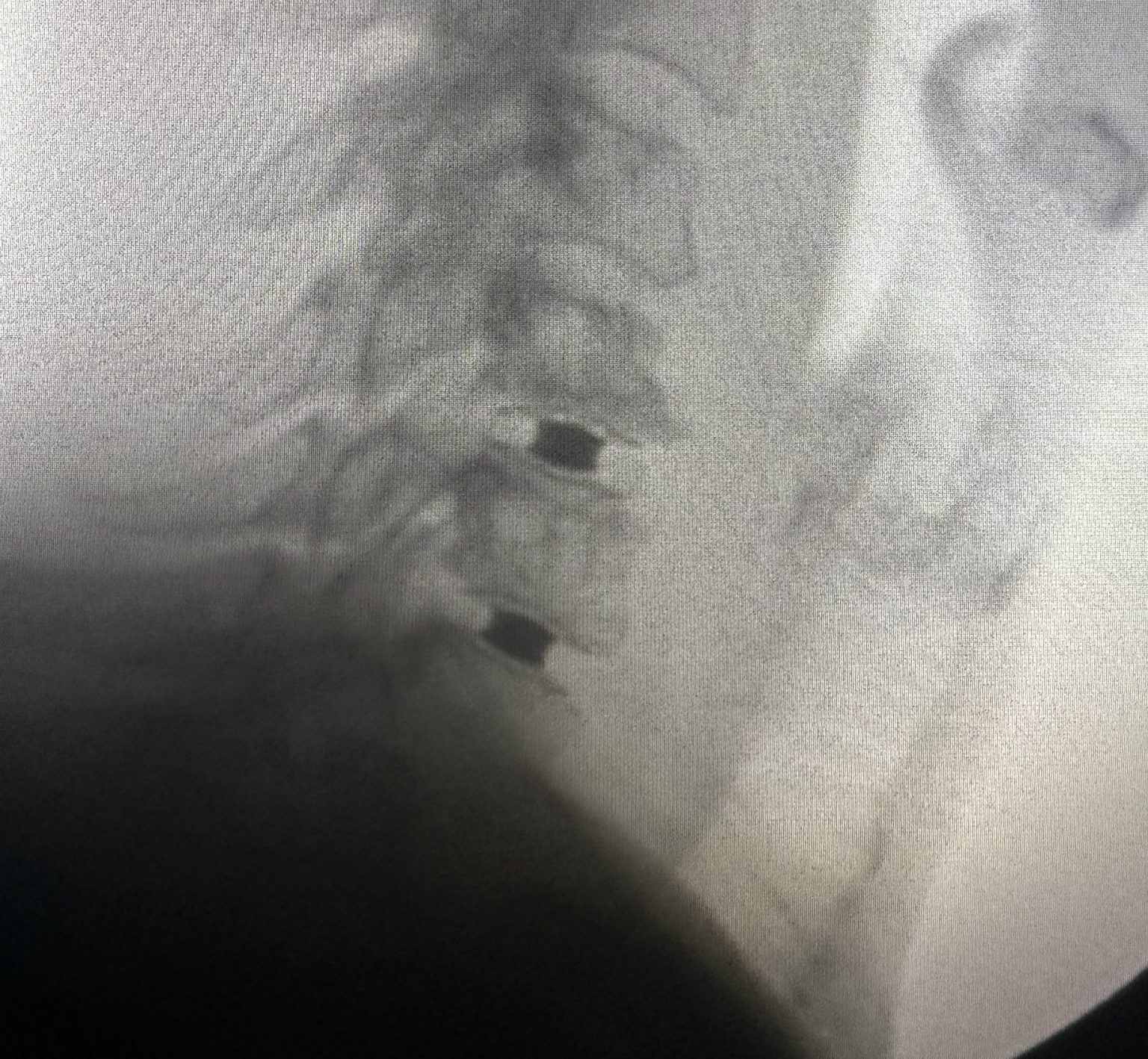 Cervical Artificial Disc Replacement - CDA Spine